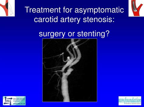 Ppt Treatment For Asymptomatic Carotid Artery Stenosis Surgery Or
