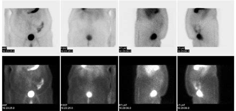 Nuclear Medicine Meckels Scan Following Intravenous Administration Of