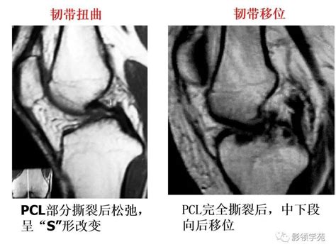 交叉韧带解剖及损伤的mri诊断膝关节