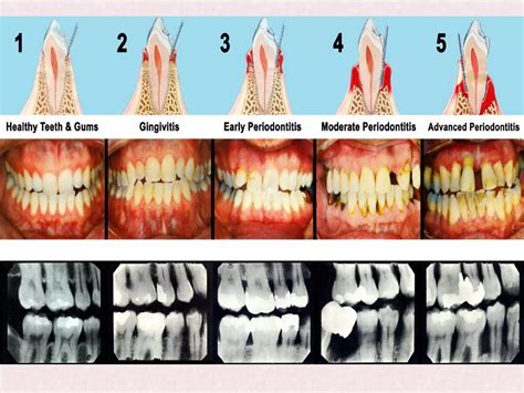Gingival Inflammation And Features Pptx