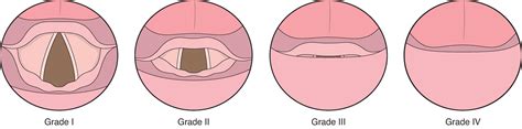 Grade 2 Laryngoscopic View At Ellen Franklin Blog