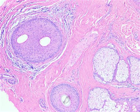 VIDEO Is Hair Transplant Possible For Scarring Alopecia Patients LPP CCCA More Dr U Hair