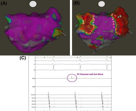 Carto‐guided Electroanatomical Maps Posterior View Pre‐ A And Download Scientific Diagram