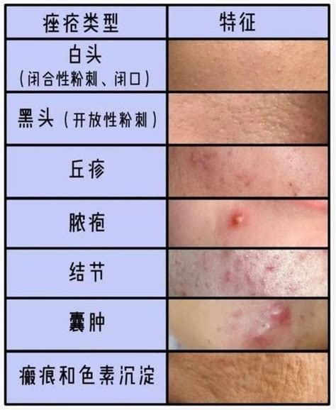 毛囊脂肪栓 图库 五毛网