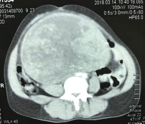 Vietnamese Medic Ultrasound Case 483 Uterine Giant Myoma Dr Phan