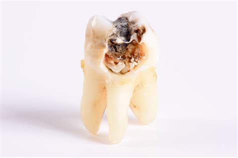 Exploring The Fascinating History Of Endodontics Modern Care Endodontics