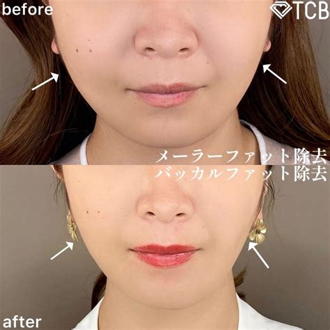 症例写真 ：メーラーファット除去 美容整形はtcb東京中央美容外科