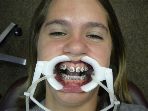 Elegante Braces