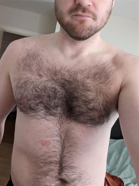 Unusual Rash Which Is Spreading R Dermatologyquestions