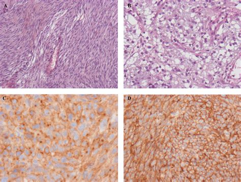 Histologic Features Of Gastrointestinal Stromal Tumors Gists A Download Scientific Diagram
