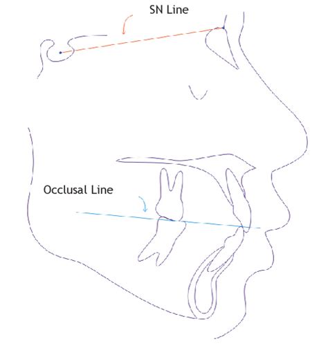 What Is Occlusal Plane At Maddison Joyce Blog