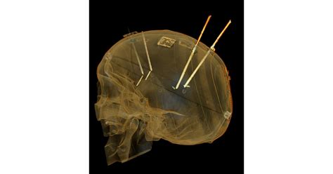 Novarads Visar System Demonstrates High Accuracy For Evd Placement
