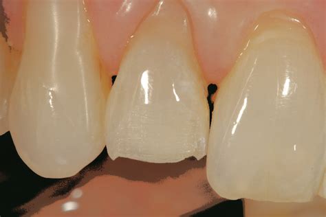 Totally Simplified Colour Matching Single Shade Direct Composite