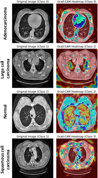 Ensemble Based Multiclass Lung Cancer Classification Using Hybrid Cnn Svd Feature Extraction And