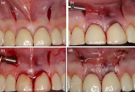 Modified Vestibular Incision Subperiosteal Tunnel Access M‐vista