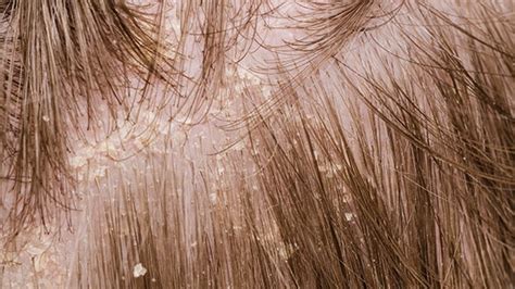 3 Common Types Of Scalp Problems Tricholab