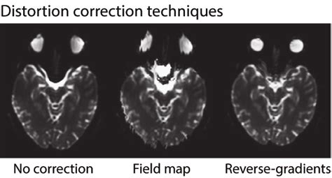 Epi Image Distortions Without Correction Left Field Map Corrected Download Scientific