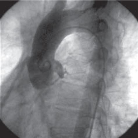 Multislice Computed Tomography Confirms Left Main Download Scientific Diagram
