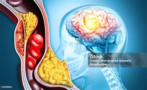 Stroke Otak Masalah Hemoragik Dan Iskemik Arteriosklerosis Infark Stroke Otak Masalah Hemoragik Dan Iskemik Arteriosklerosis Infark