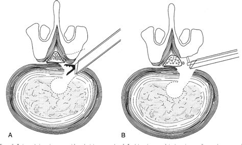 Figure 1 From Posterolateral Endoscopic Excision For Lumbar Disc