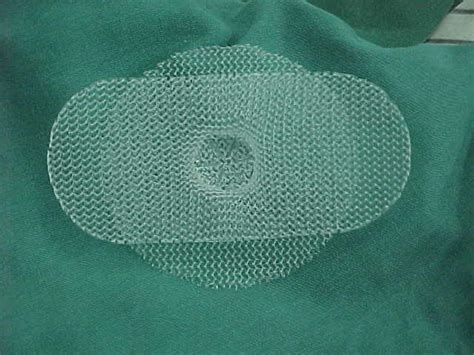 Prolene Hernia System Download Scientific Diagram