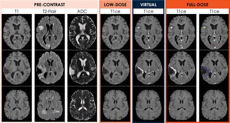 Figure 3 From Contrast Enhanced Brain Mri Synthesis With Deep Learning Key Input Modalities And