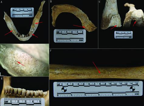 Pathological Lesions On The Bones And Teeth Of Individuals In M56 A