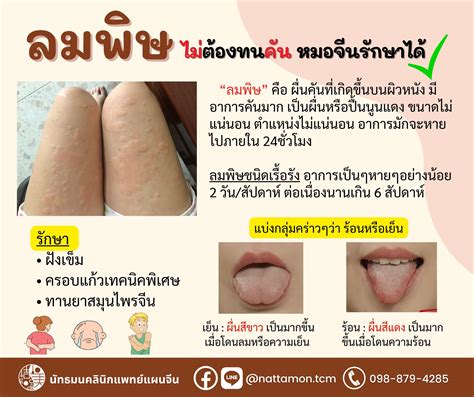 ใครเคยเป็นลมพิษบ้าง แล้วเข้าข่ายกลุ่มอาการไหนกันบ้างคะ หมอแพนเคยเป็น