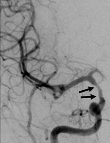 Focal Cerebral Arteriopathy Fca Stroke Manual