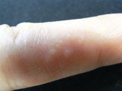 手の指の汗疱はコレが原因治療法や薬を知ってる トリビアーノ