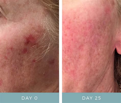 Before After Chemotherapy Fluorouracil Skin Side Effects