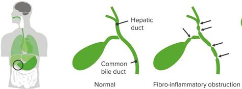 Pediatric Biliary Atresia Diagnosis And Surgery Medical Library