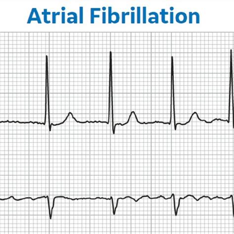 No Afib Symptoms Risks Of Undiagnosed Afib Ge Healthcare Malaysia