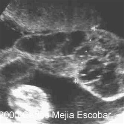 📃 Klippel Trenaunay Weber Syndrome