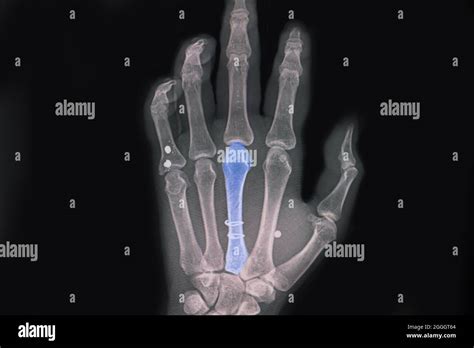 Spiral Fracture In Hand