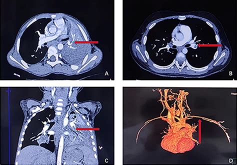 A Ctpa Revealed Consolidation With High Density In The Left Lower Lobe Download Scientific