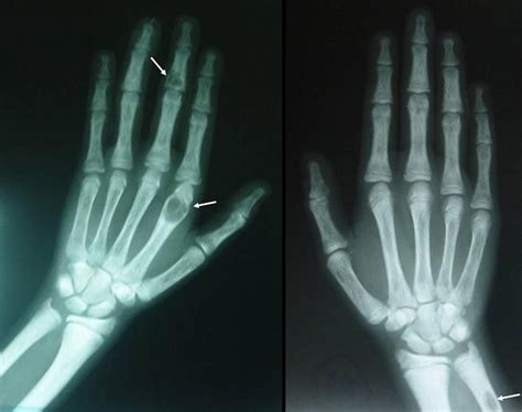 Hyperparathyroidism Symptoms Causes Diagnosis And Treatment Natural Health News