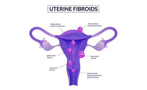 Myomectomy Surgery For Uterine Fibroids Removal Uterine Fibroid