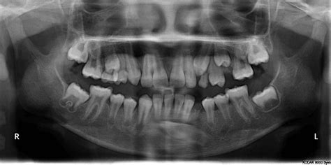 Diversities In Presentations Of Extrapulmonary Tuberculosis Bmj Case
