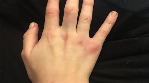 Bruised Knuckles