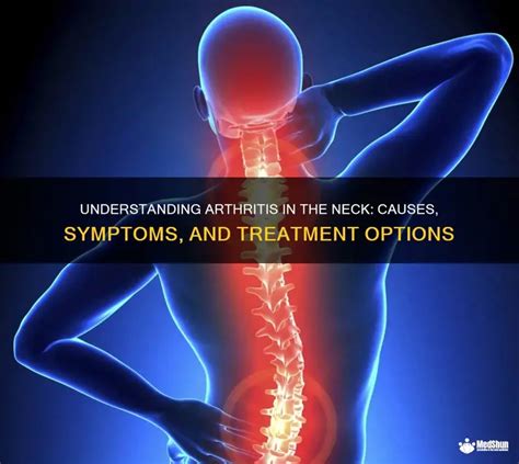 Understanding Arthritis In The Neck Causes Symptoms And Treatment