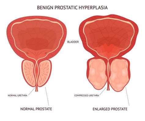 Prostate Illustrations Royalty Free Vector Graphics And Clip Art Istock