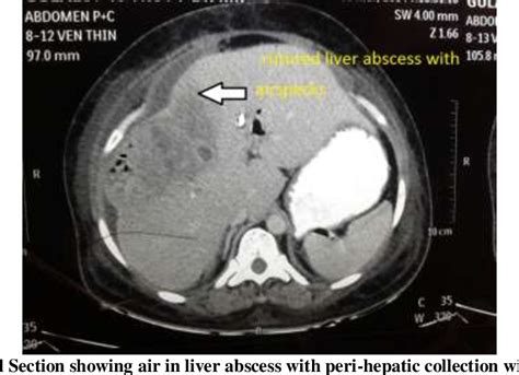 Figure 1 From Post Ercp Cholangitic Liver Abscess Rupture Causing