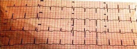 ECG Showing T Wave Inversions In Inferolateral Leads Download Scientific Diagram