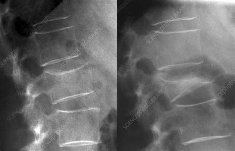 Osteoporosis And Vertebral Fractures At Katie Felton Blog