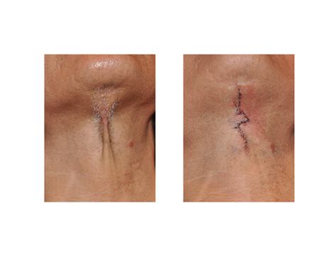 The Z Plasty Scar Revision Technique Explore Plastic Surgery