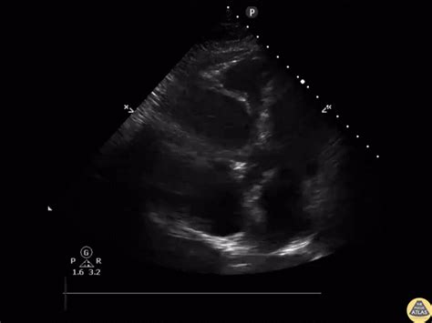 Echocardiography — Tpa