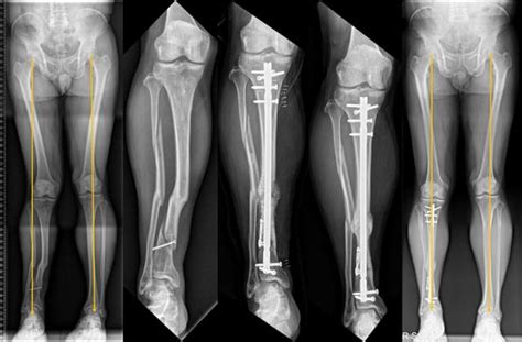 골절 수술 후 뼈가 잘 붙지 않는다면 불유합 의심 한국일보