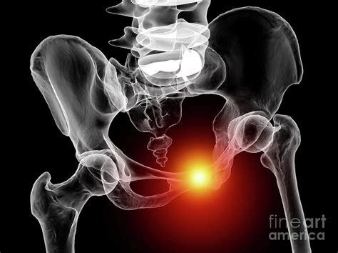 Symphysis Pubis Dysfunction By Kateryna Konscience Photo Library