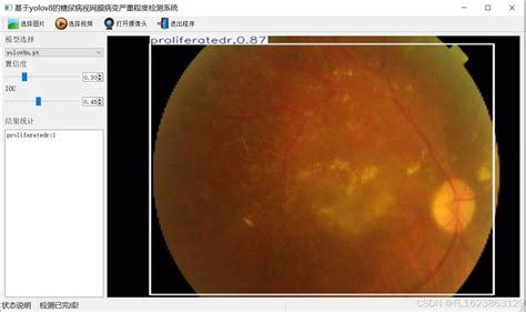 基于yolov8的糖尿病视网膜病变严重程度检测系统python源码pytorch模型评估指标曲线精美gui界面圆锥角膜筛查